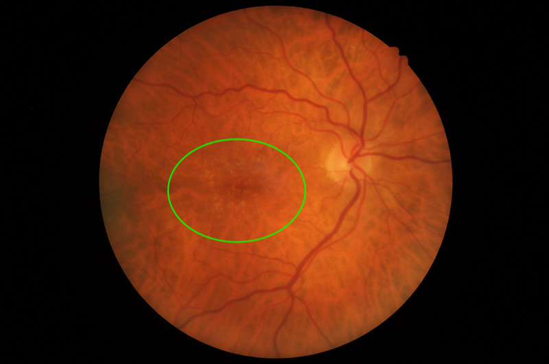 Macular Dystrophy Retina